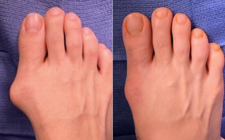 Webbed Toe Seperation Surgery | Syndactyly Surgery | Joined Toes