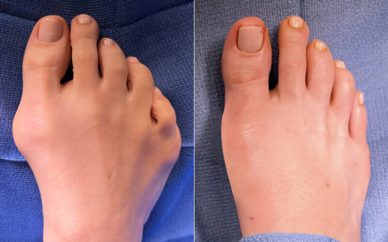 Webbed Toe Seperation Surgery | Syndactyly Surgery | Joined Toes